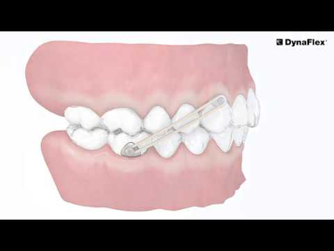 PRECISION ALIGNER BUTTONS – Main Orthodontics